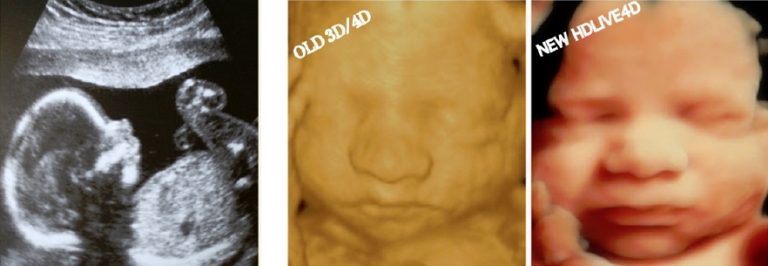 Where Can I Get a 3D Ultrasound Near Me | 3D 4D HD Virginia
